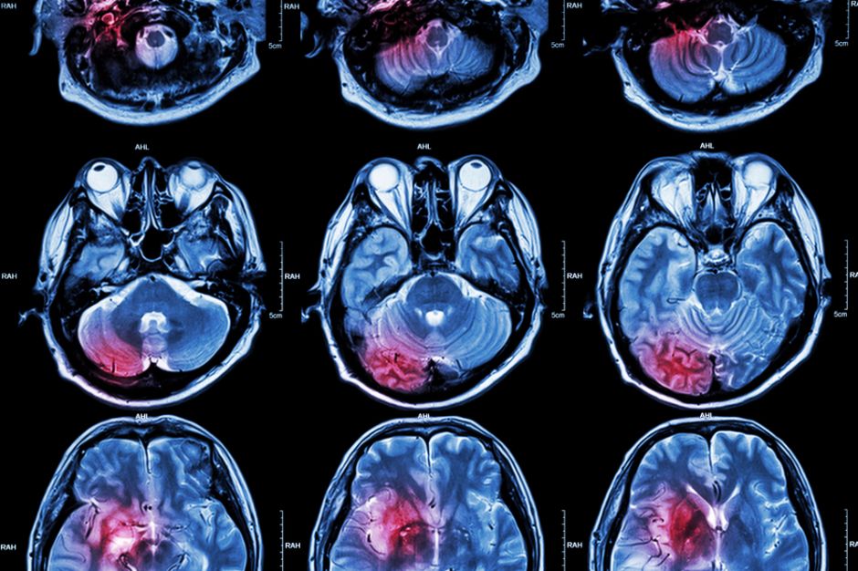 Los S ntomas Que Advierten De Un Derrame Cerebral El Diario NY los-s-ntomas-que-advierten-de-un-derrame-cerebral-el-diario-ny