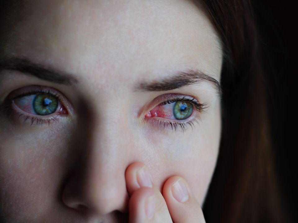 ¿Cuáles son las causas de los ojos rojos? - El Diario NY