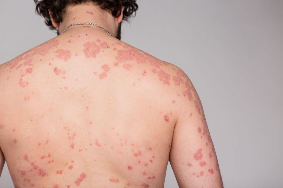 Qué es la psoriasis y cuáles son sus síntomas | El Diario NY