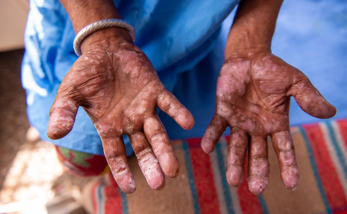 CDC informan que la lepra se ha convertido en una enfermedad endémica ...