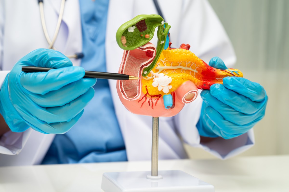¿Puedo morir por una pancreatitis? Expertos lo aclaran - El Diario NY